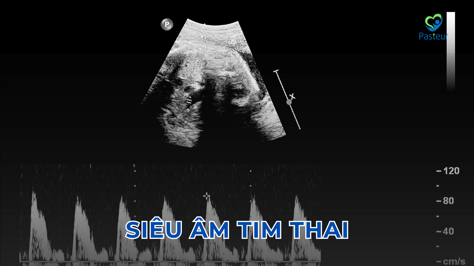 Siêu Âm Tim Thai: 4 Điều Mẹ Bầu Cần Biết Trong Thai Kỳ