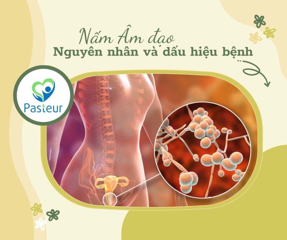 Nấm Âm Đạo - Nguyên Nhân Và Biểu Hiện Của Bệnh