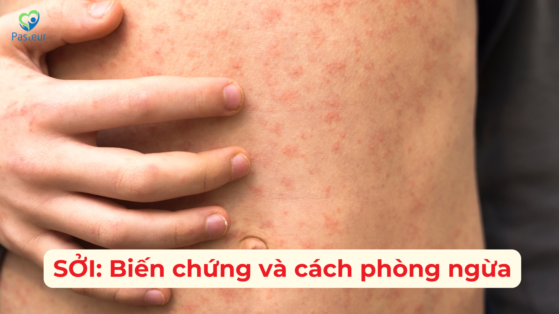 SỞI: BIẾN CHỨNG VÀ CÁCH ĐIỀU TRỊ